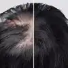 Patchy Hair Loss: ஒரே இடத்தில் முடி கொட்டி வழுக்கை மாதிரி ஆகுதா? இந்த 6 ...