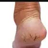 Foot Crack Treatment At Home,பாளம் பாளமா வெடிச்சிருக்கிற பாதத்தை ஒரே ...
