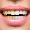 How To Clean Yellow Teeth,yellow teeth : மஞ்சள் பற்களை வெள்ளையாக்கும் ...