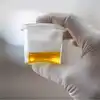 Causes For Hot Urine,Hot Urine: ಕೆಲವೊಮ್ಮೆ ಮೂತ್ರ ಸಾಮಾನ್ಯಕ್ಕಿಂತಲೂ ಹೆಚ್ಚು ...