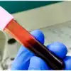 CRIB Blood Group: ವಿಶ್ವದಲ್ಲೇ ಪತ್ತೆಯಾಗದ ಅಪರೂಪದ ರಕ್ತದ ಗುಂಪು, ಕೋಲಾರ ...